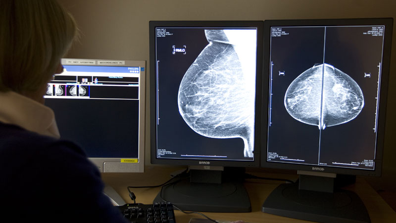 'Medische doorbraak borstkanker'